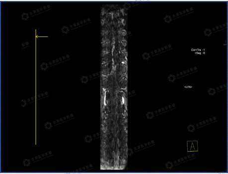 六、脊髓血管MRA的临床应用|上海大学附属上海全景医学影像诊断中心|全景医学影像